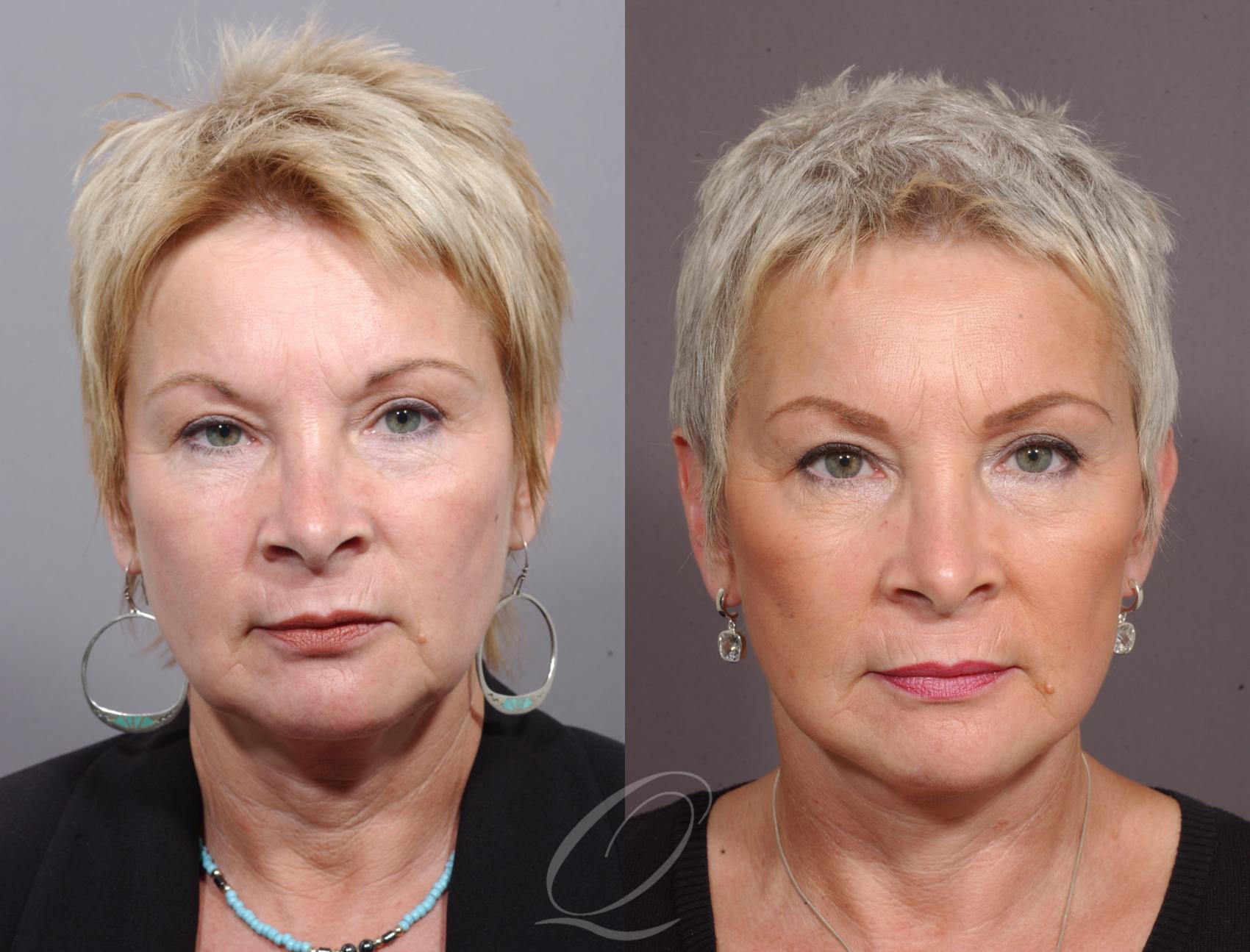 Facelift Before & After Photo Gallery | Serving Rochester, Syracuse ...