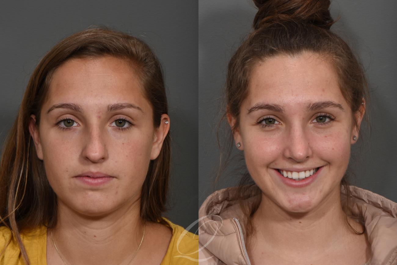 Rhinoplasty Before & After Photo Gallery | Serving Rochester, Syracuse ...